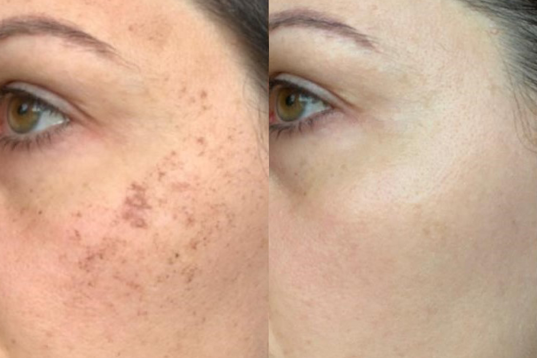 How To Reduce Facial Pigmentation – Medicetics