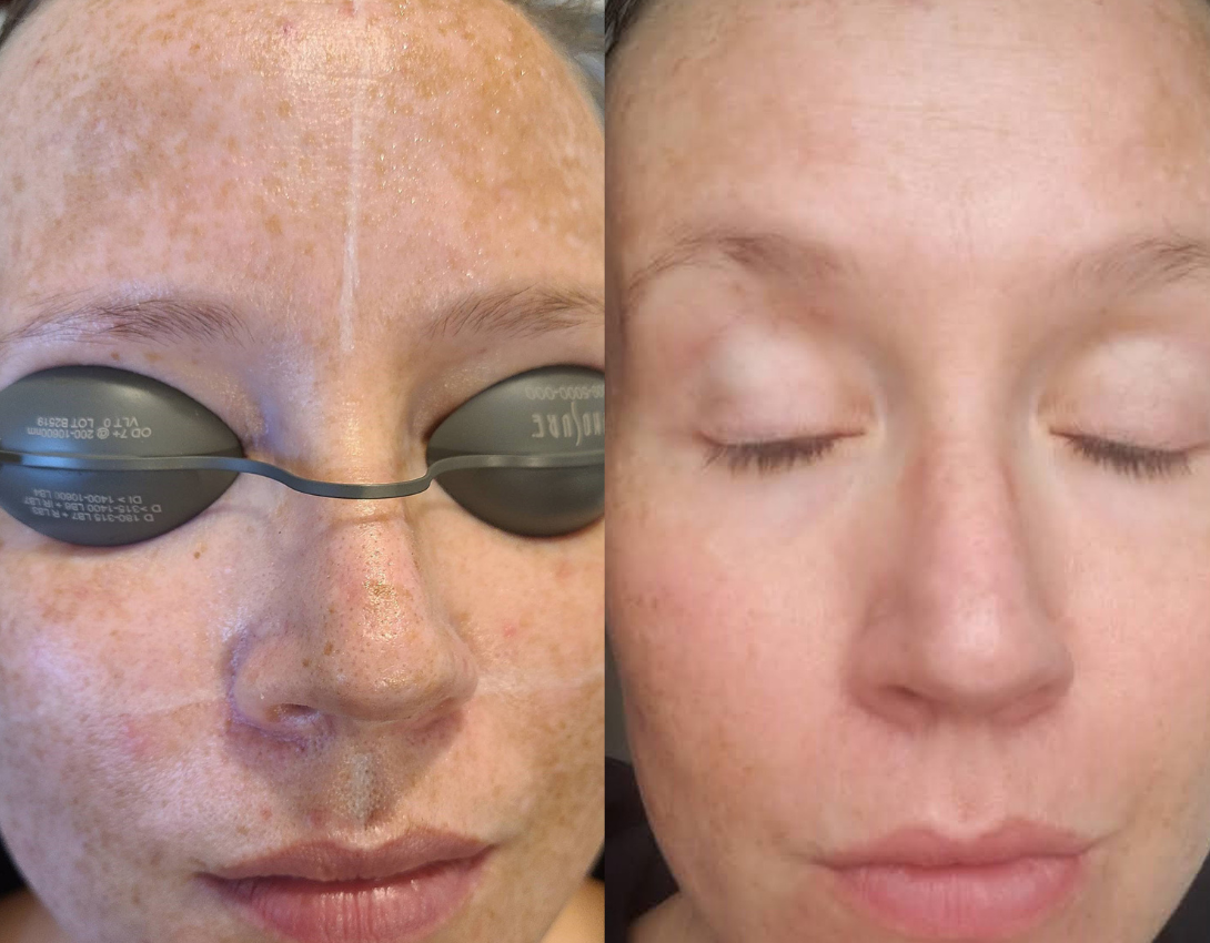 IPL Photofacial | 1540 Non-Fraxel Laser Treatment in Central London ...