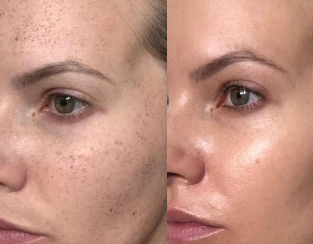 IPL Photofacial | 1540 Non-Fraxel Laser Treatment in Central London ...
