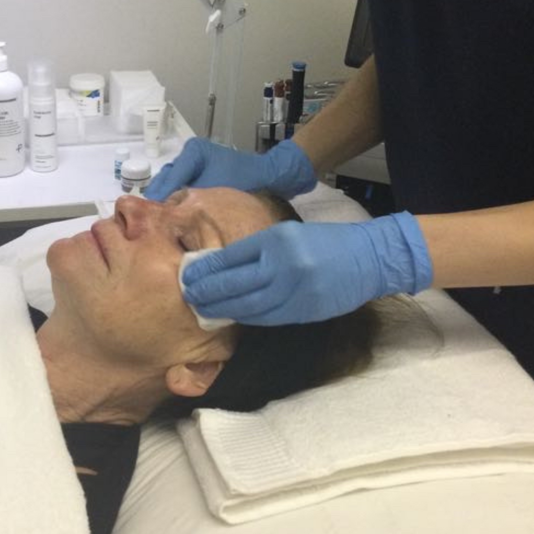 Cosmelan Depigmentation Peel Treatment, Central London – Medicetics