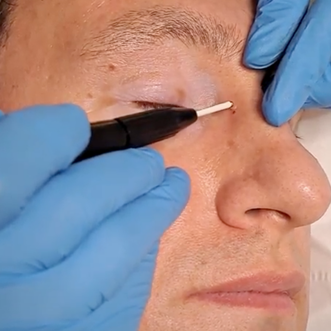 Same Day Mole Removal Treatments in Central London – Medicetics