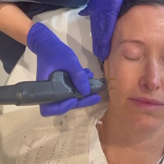 NeoGen Plasma, Skin Regeneration Treatment – Medicetics