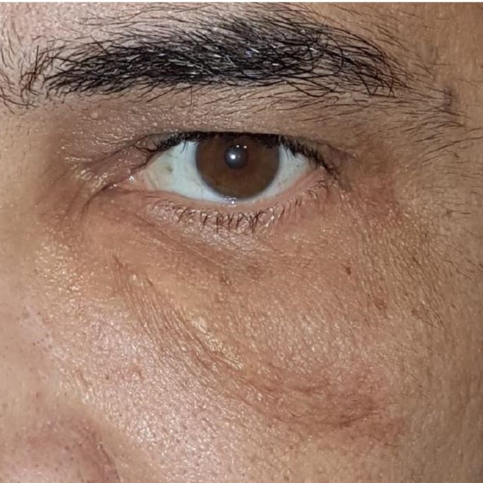 NeoGen Plasma, Skin Regeneration Treatment – Medicetics