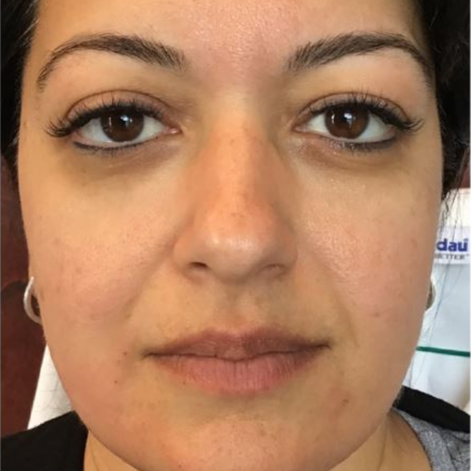 NeoGen Plasma, Skin Regeneration Treatment – Medicetics