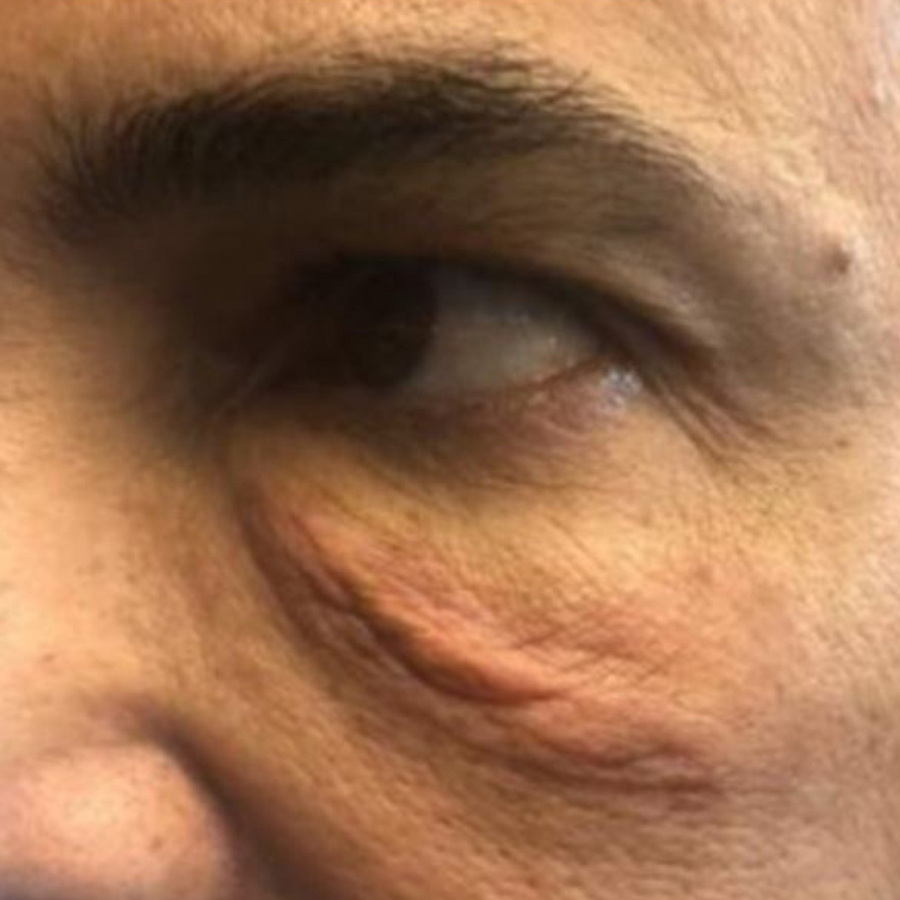 NeoGen Plasma, Skin Regeneration Treatment – Medicetics