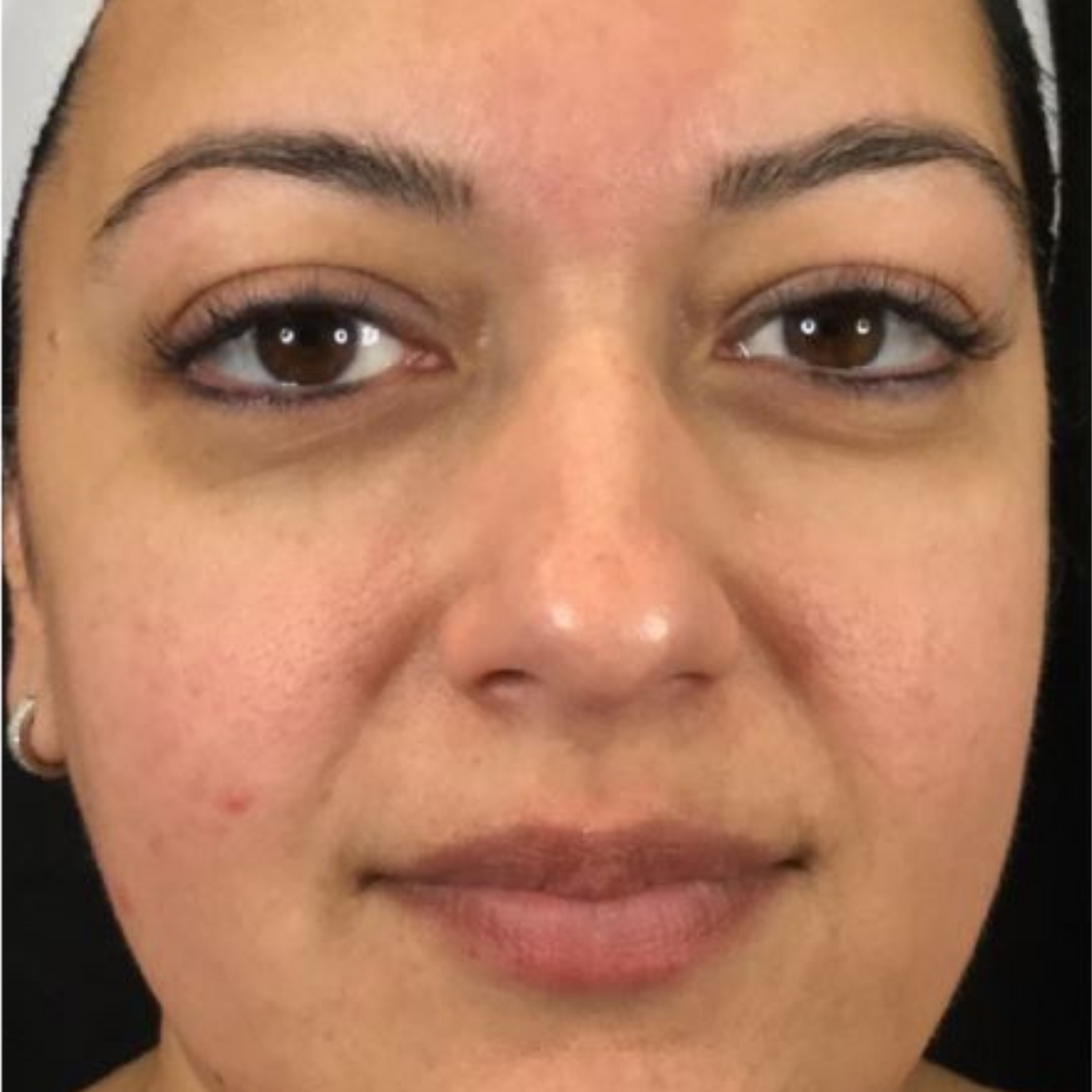 NeoGen Plasma, Skin Regeneration Treatment – Medicetics