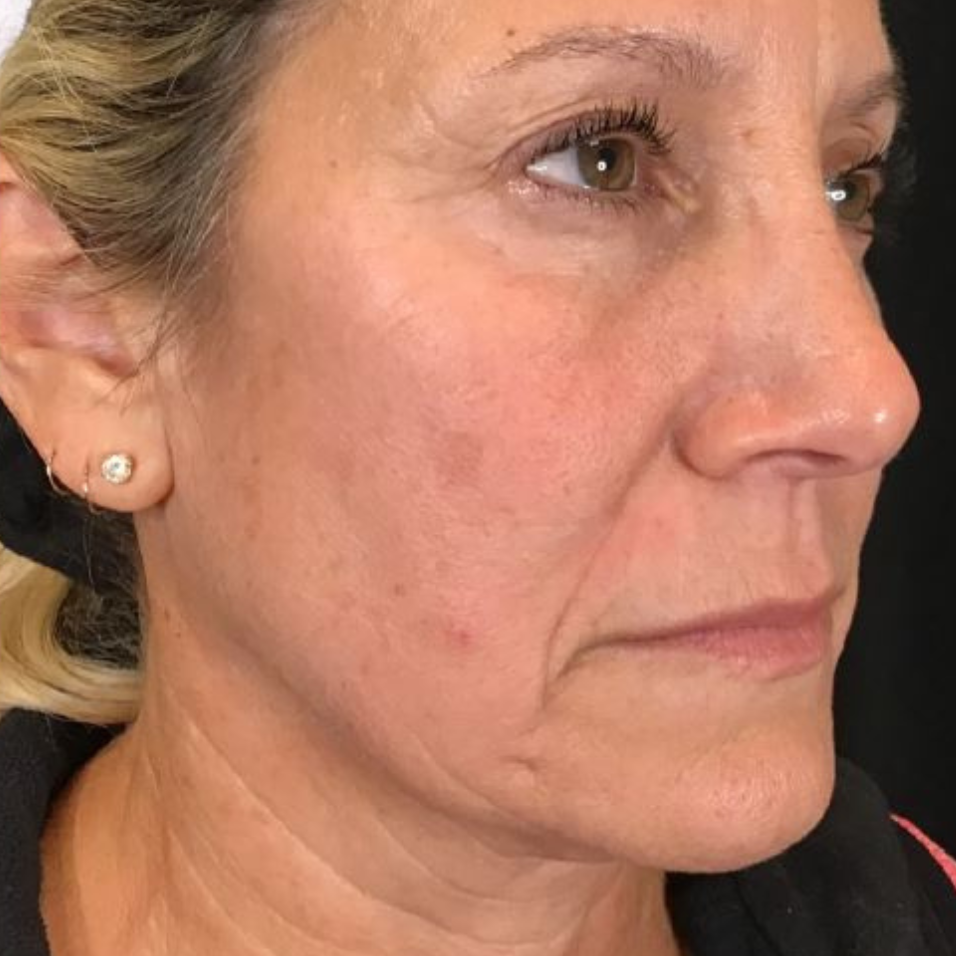 NeoGen Plasma, Skin Regeneration Treatment – Medicetics