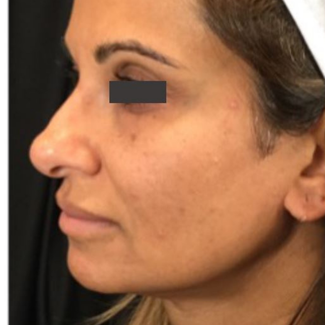 NeoGen Plasma, Skin Regeneration Treatment – Medicetics