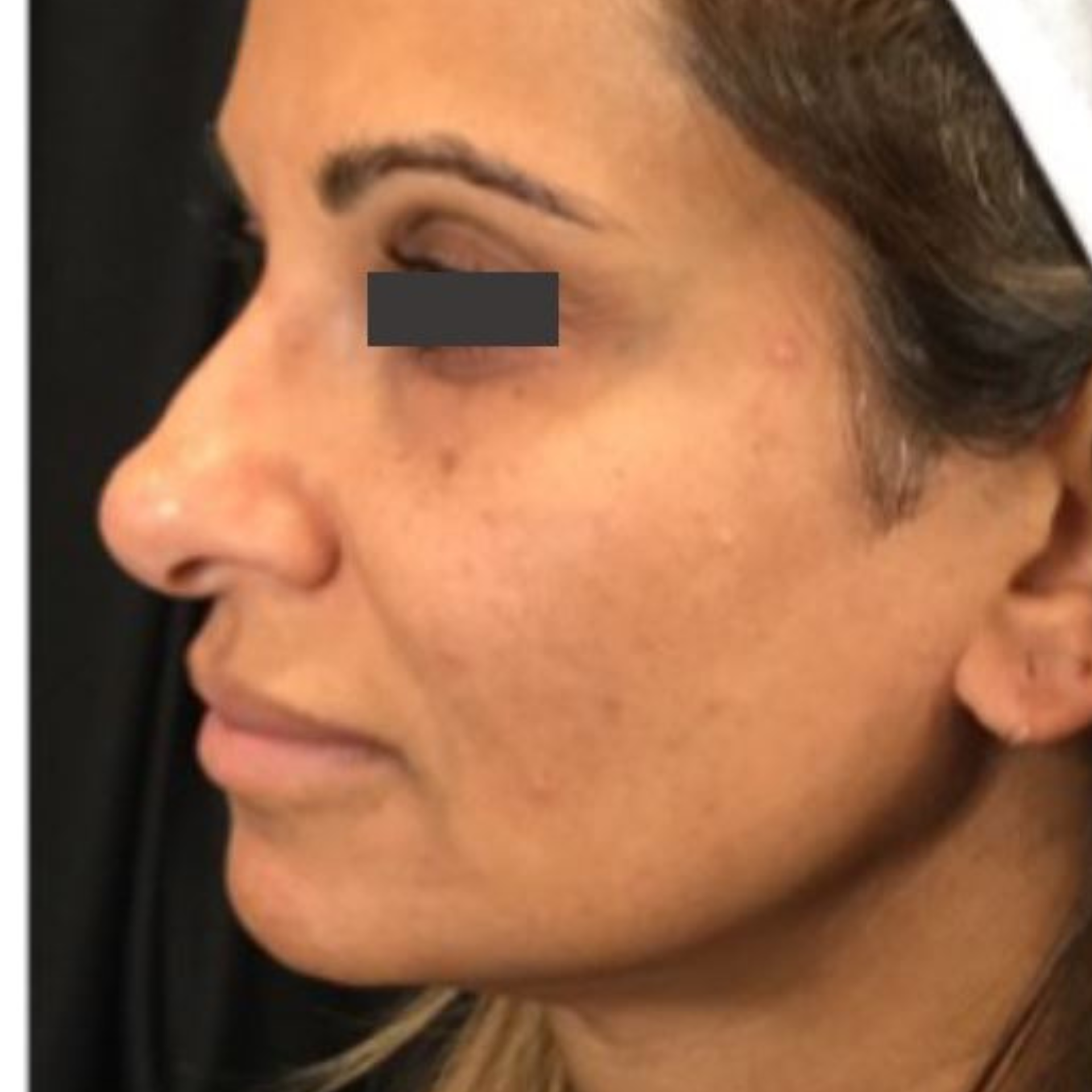 NeoGen Plasma, Skin Regeneration Treatment – Medicetics